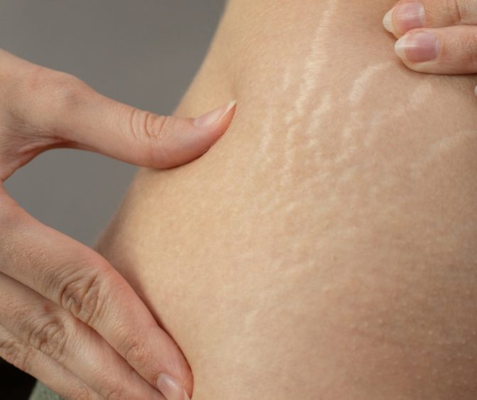 Laser Stretch Mark Removal | Stretch Mark Reduction Near Me